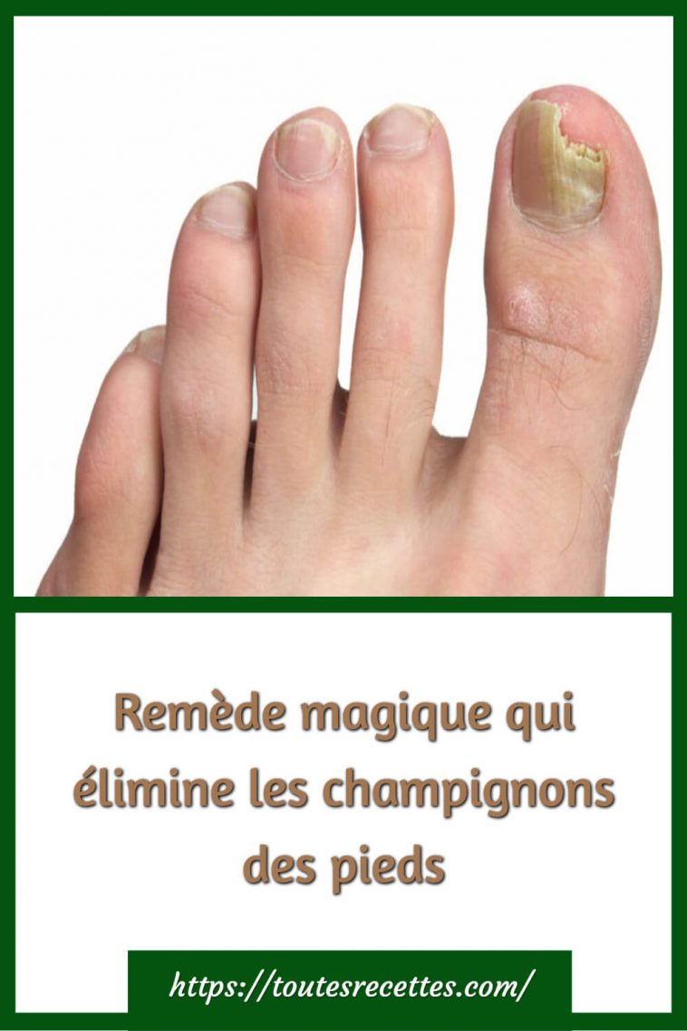 Remède magique qui élimine les champignons des pieds – Toutes Recettes