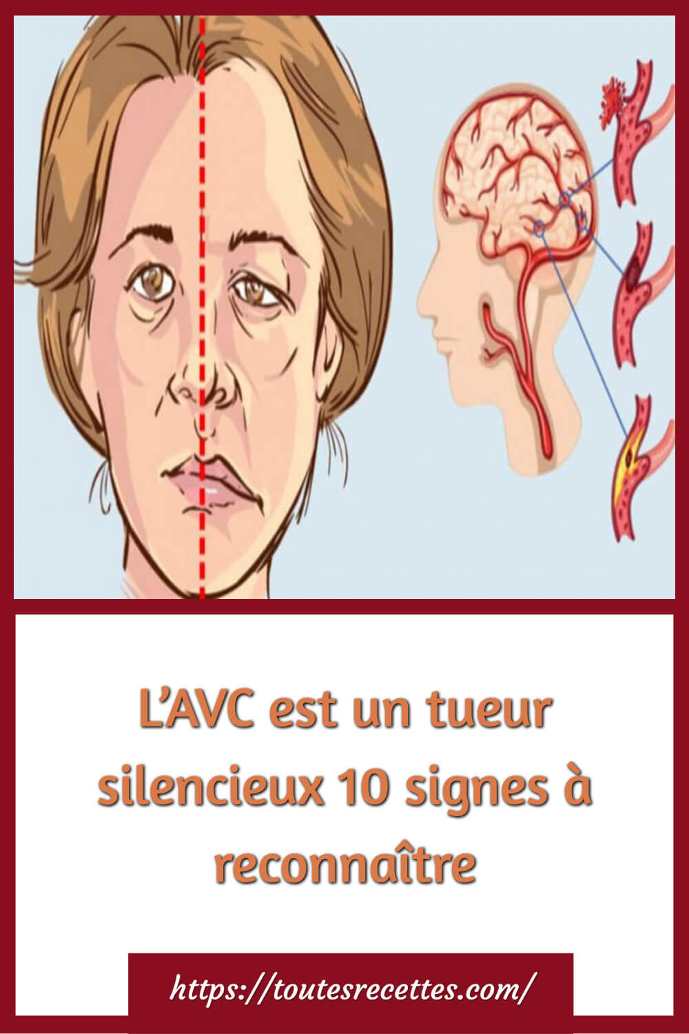 L’AVC est un tueur silencieux 10 signes à reconnaître – Toutes Recettes